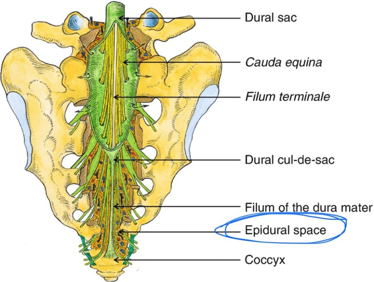 Epidural Labor Analgesia. – The Dark Neb: Tuohy Time
